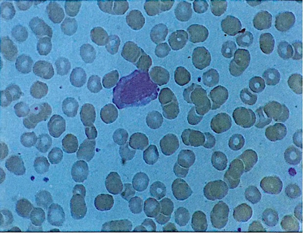 Infectious Mononucleosis Blood Smear